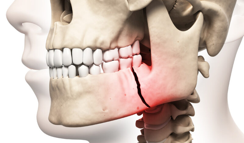 Facial Trauma | Bothell OMIS